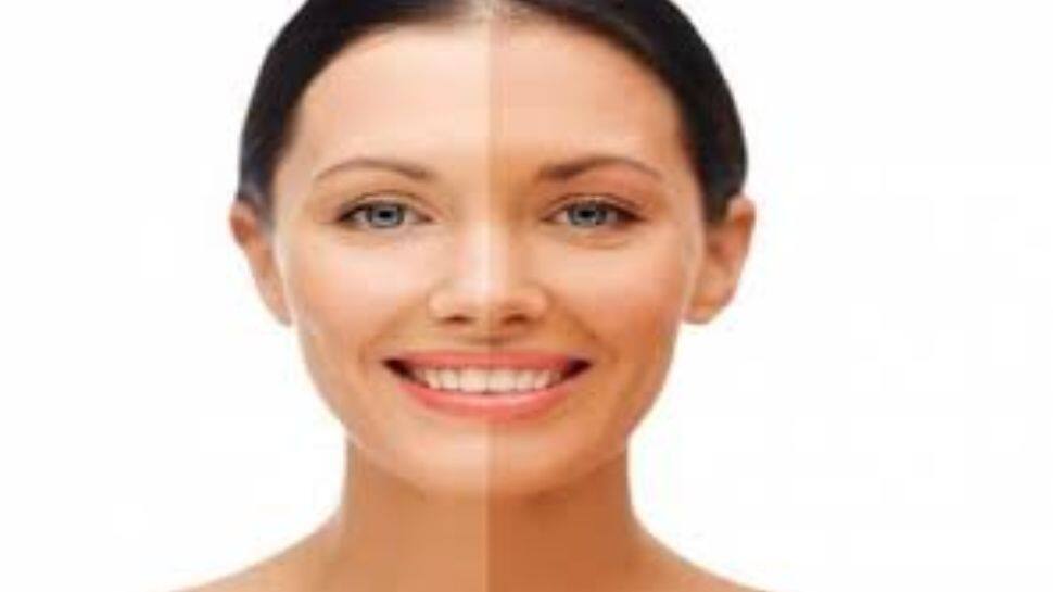 Forehead Tanning: Easy Home Remedies here | நெற்றியில் ஏற்படும் நிற ...