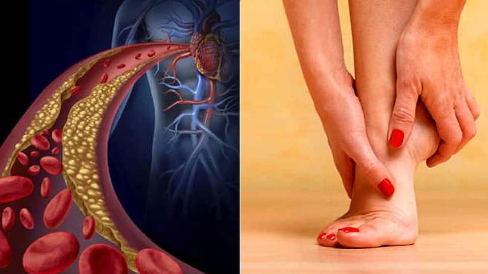 Sings Of High Cholesterol In Legs | அடிக்கடி இந்த இடத்துல வலி இருக்கா ...
