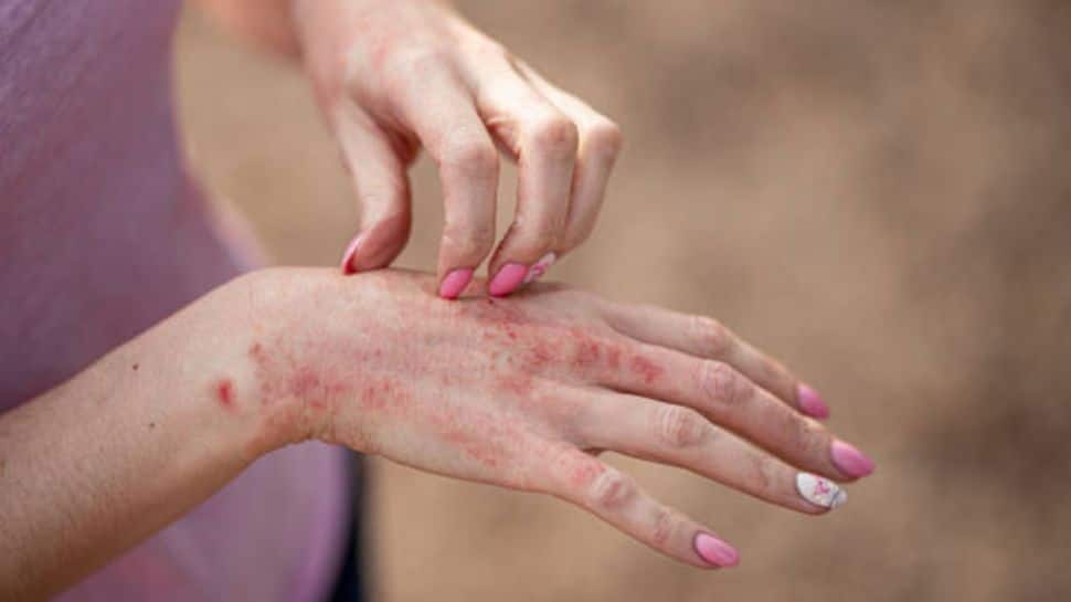 beat-the-heat-with-home-remedies-to-fix-skin-allergy-in-summer ...