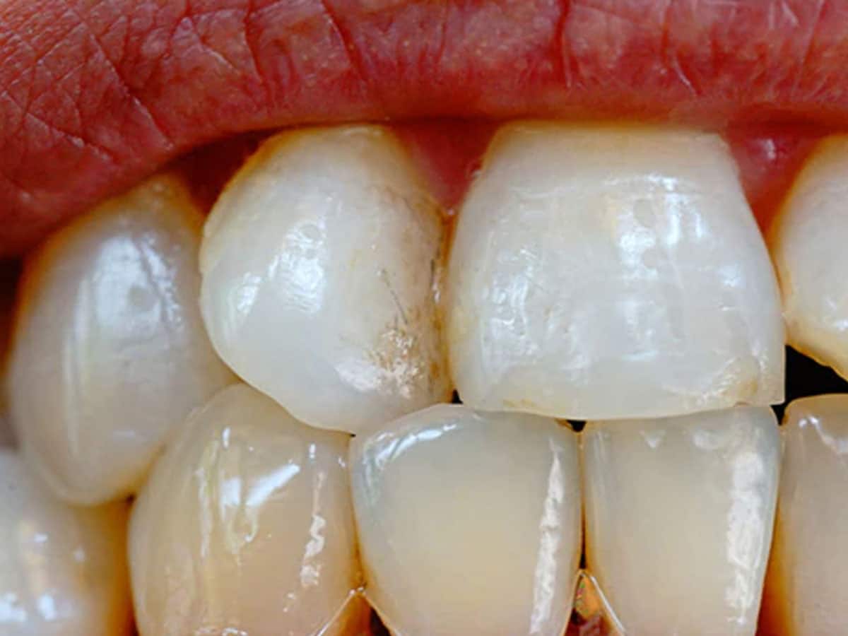 Home Remedies for Teeth Whitening | பற்களில் விடாபிடியான கறைகள் இருக்கா ...