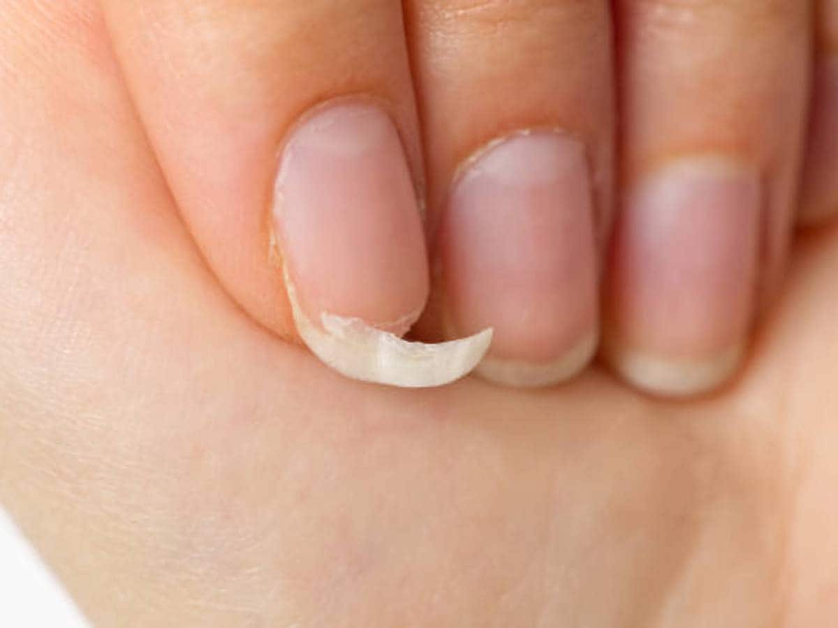 Nail Broken Do Your Nails Break Often How To Fix It Know The Details ...
