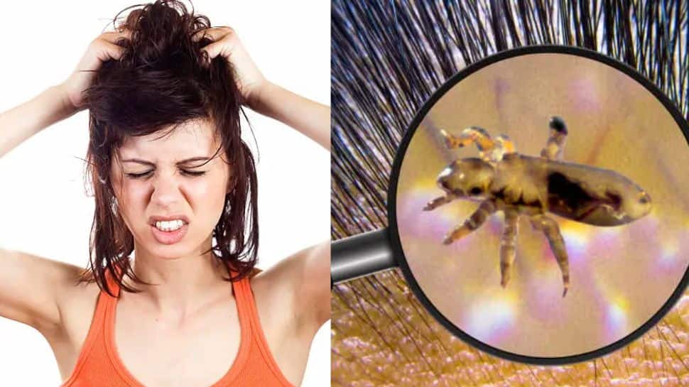 How To Get Rid Of Lice In Kids And Adults Head Follow These Tips At ...