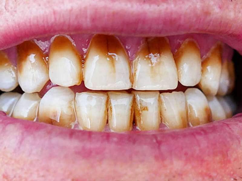 Home Remedies For Yellow Teeth | அருவெறுப்பான மஞ்சள் பற்கள் முத்து போல் ...